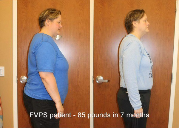 Lateral Side by Side | Fox Valley Plastic Surgery, S.C.