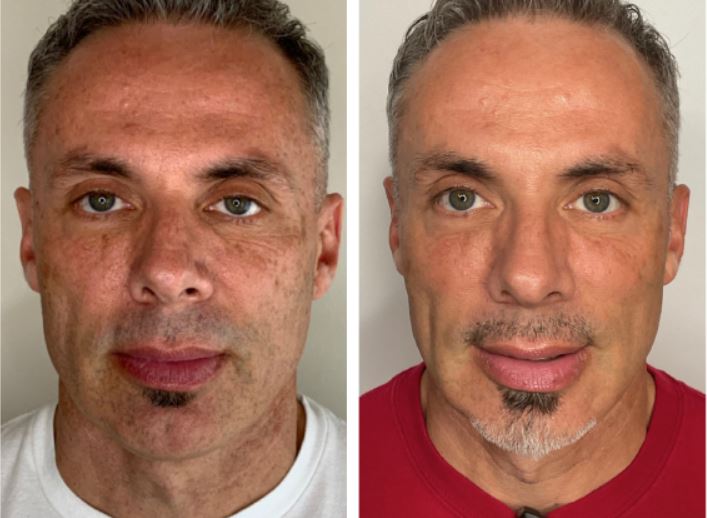 Sylfirm X Microneedling | Fox Valley Plastic Surgery, S.C.